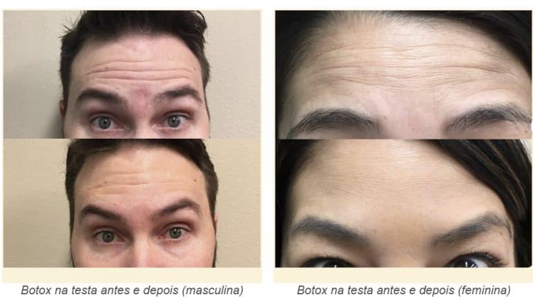 Revelando a verdade por trás do Botox na testa: desmascarando mitos e ...